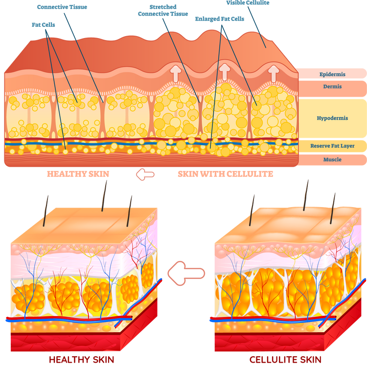CelluAid – #1 Trusted Best Cellulite Cream